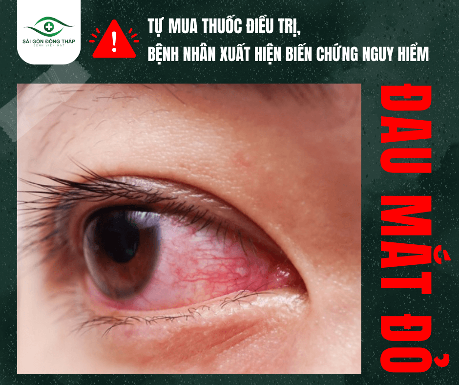 Tự mua thuốc điều trị đau mắt đỏ, bệnh nhân xuất hiện biến chứng nguy ...